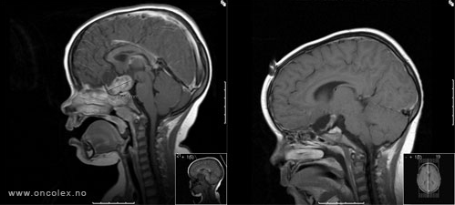 Overlevelse ved svulster i CNS hos barn