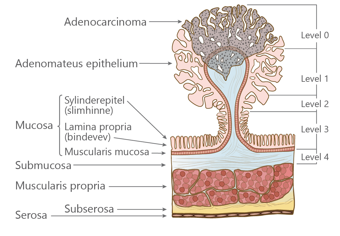 Operasjoner for kreft i tykktarmen