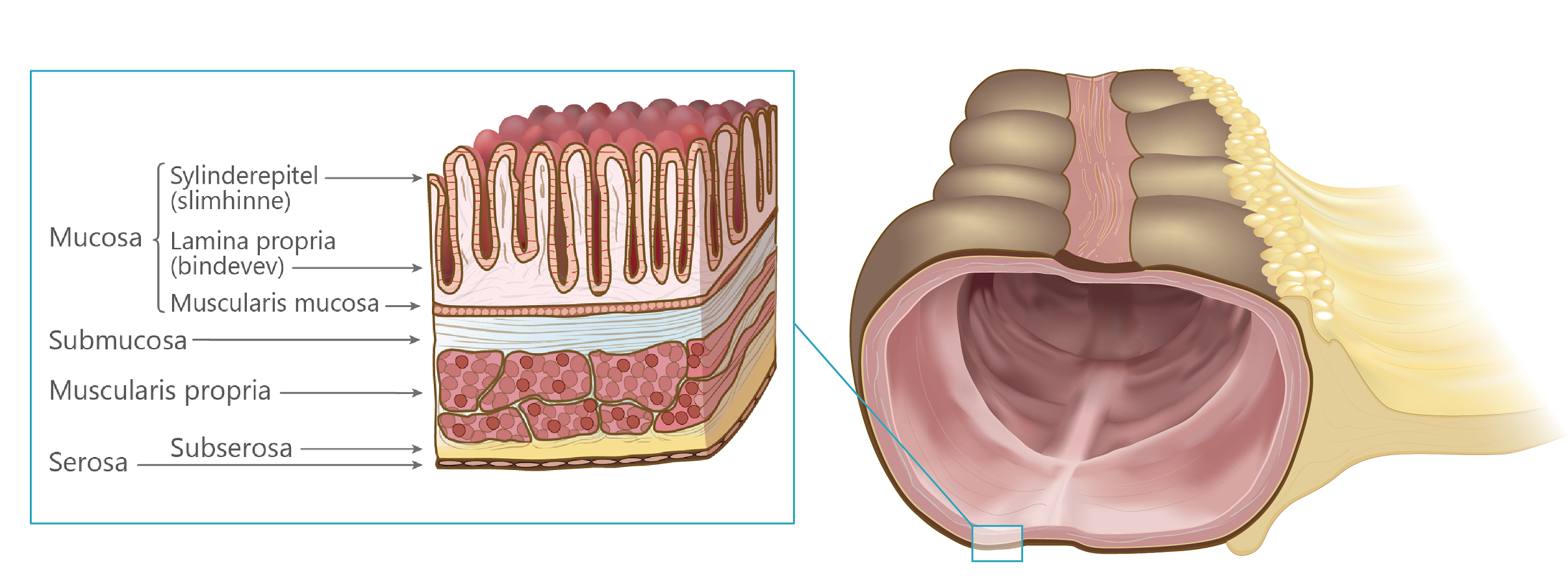 Vekst og spredningsmønster ved tarmkreft